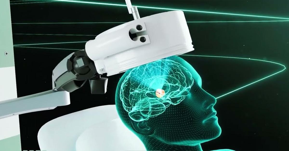 打造NaviFUS有效治療腦疾 浩宇成全球前三頂尖公司